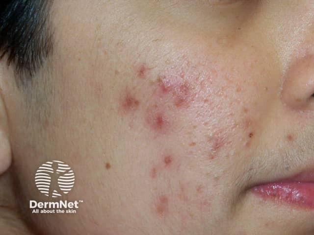 Acne | NHS inform