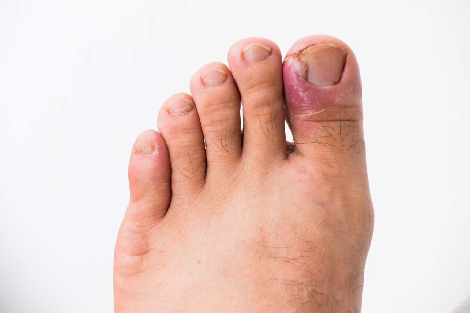 Ingrown toenail | NHS inform