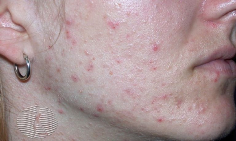 Acne | NHS inform