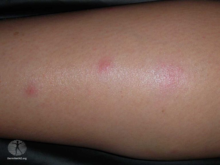 Insect bites and stings | NHS inform