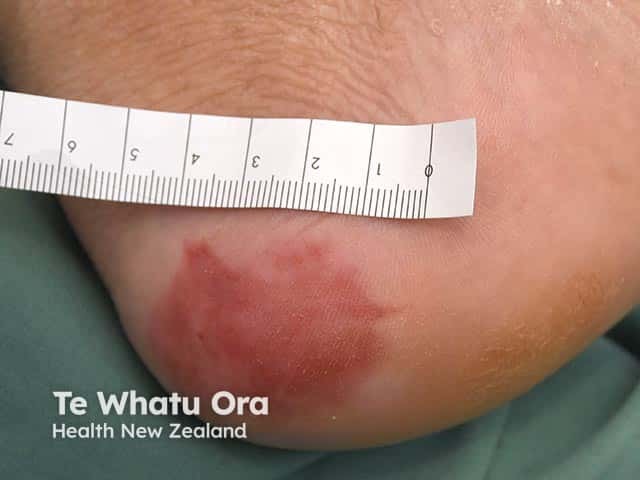 Pressure ulcers | NHS inform