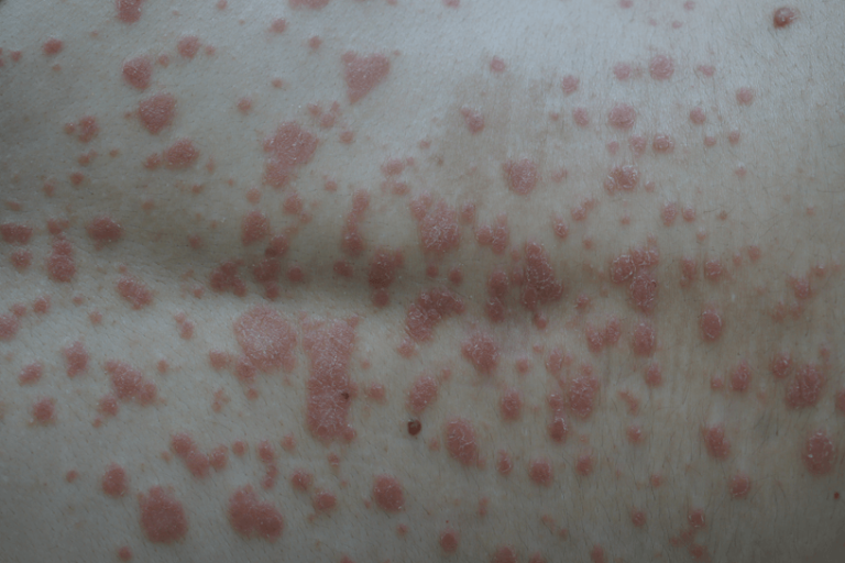 Psoriasis | NHS inform
