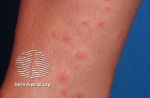 Insect bites and stings | NHS inform