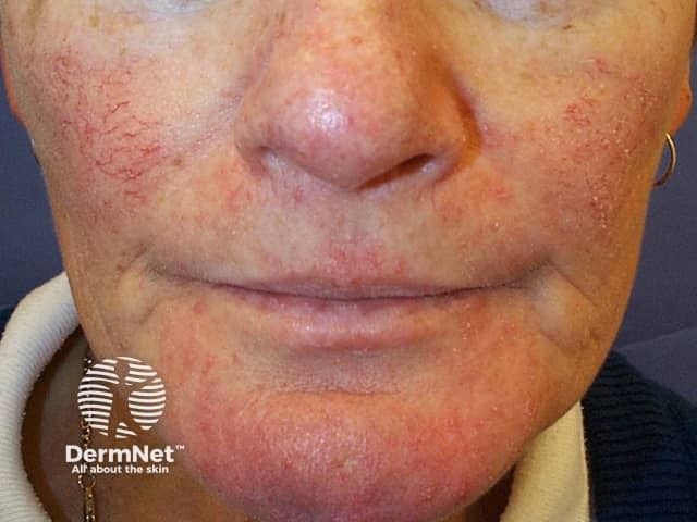 Rosacea | NHS inform