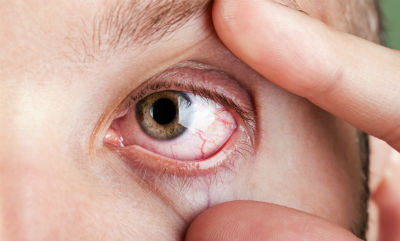 Self-help guide: Eye problems | NHS inform