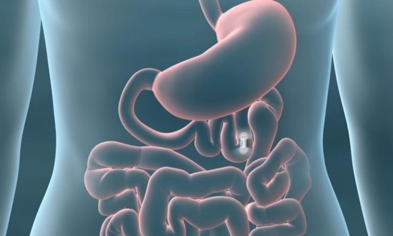 Colon capsule endoscopy (CCE) | NHS inform