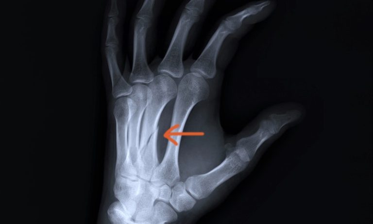 Metacarpal fracture of the hand | NHS inform