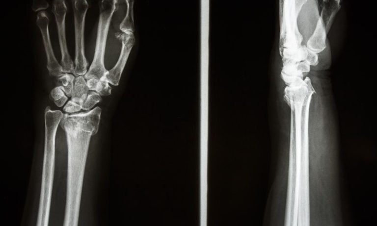 Wrist fracture | NHS inform