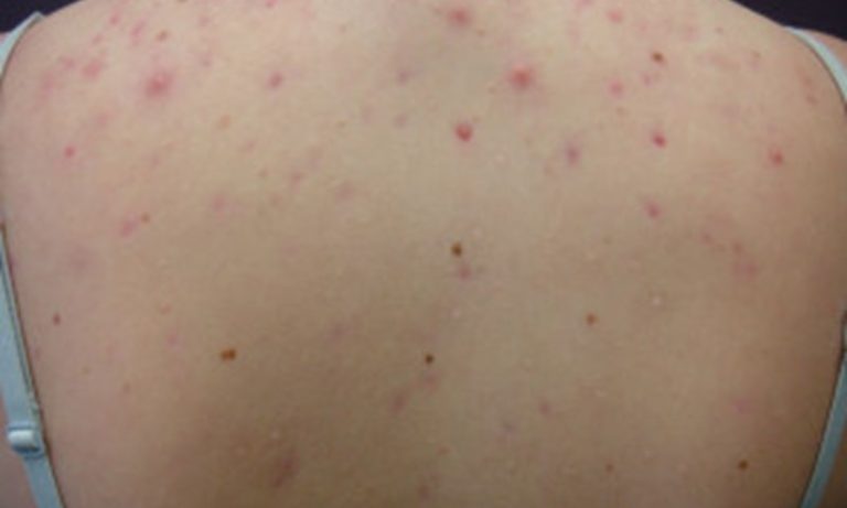 Acne | NHS inform
