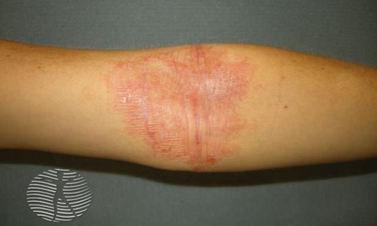 Atopic eczema | NHS inform