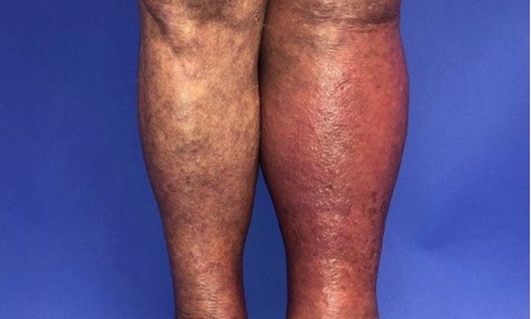 Cellulitis | NHS inform