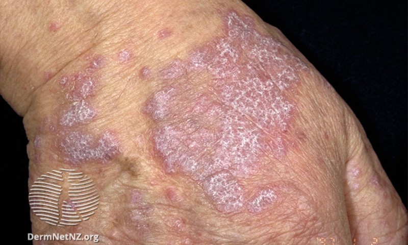 Lichen Planus NHS Inform