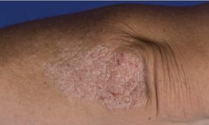 Psoriasis | NHS inform