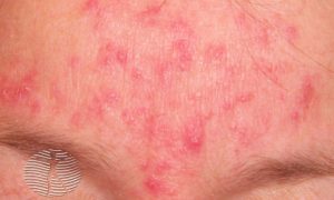 Rosacea | NHS inform