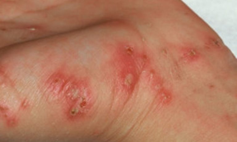 Scabies | NHS inform