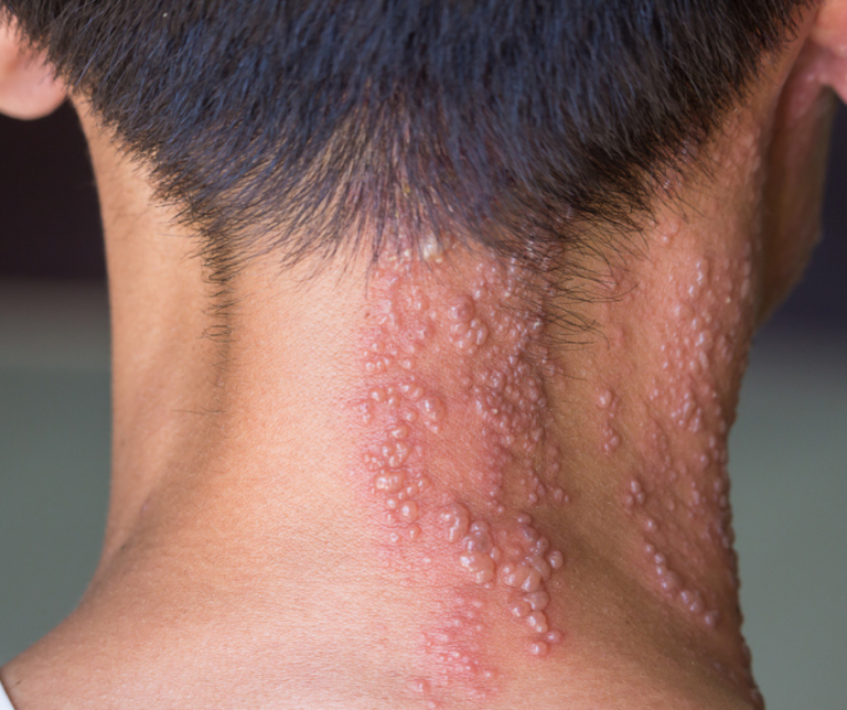 Shingles | NHS inform