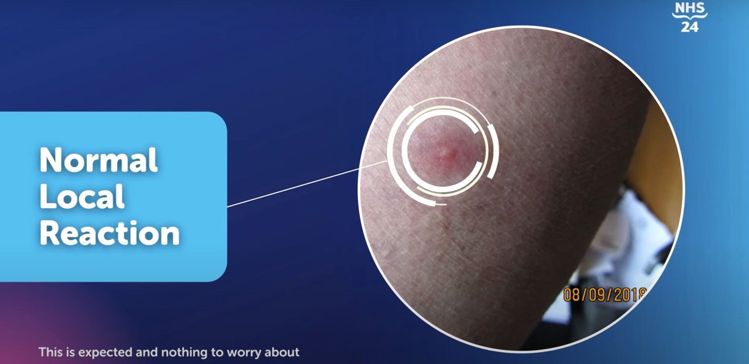 Tick bites | NHS inform