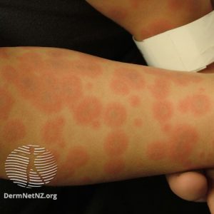 Skin rashes in children | NHS inform