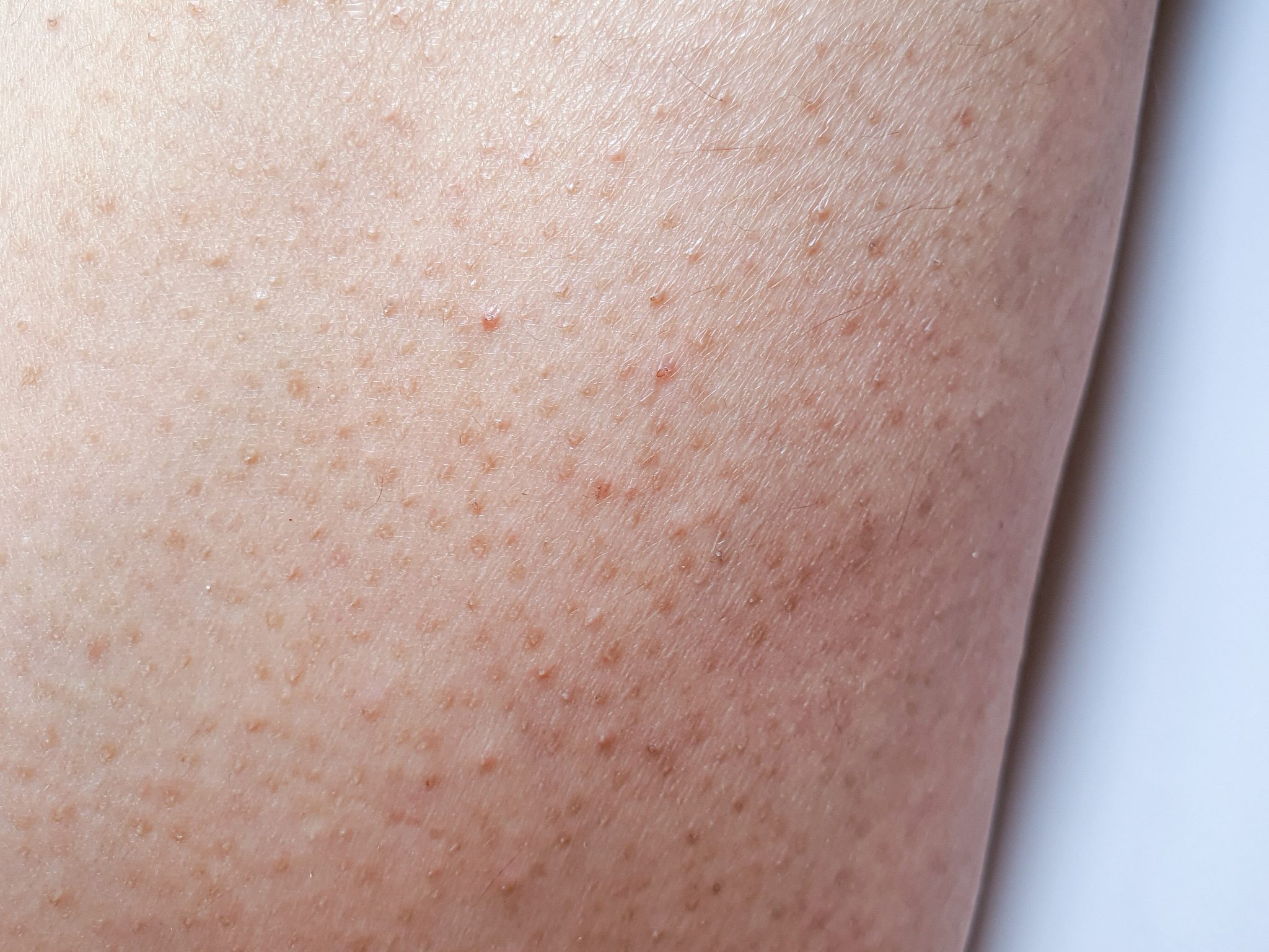 Skin rashes in children | NHS inform
