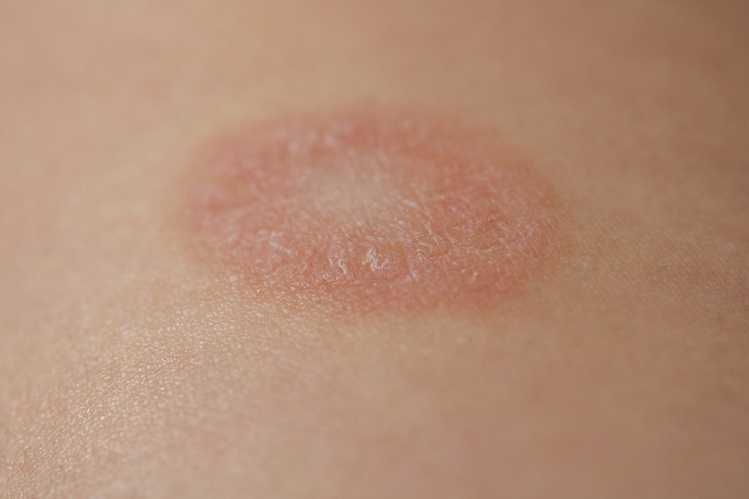 Skin rashes in children | NHS inform