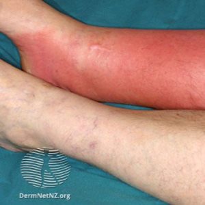 Skin rashes in children | NHS inform