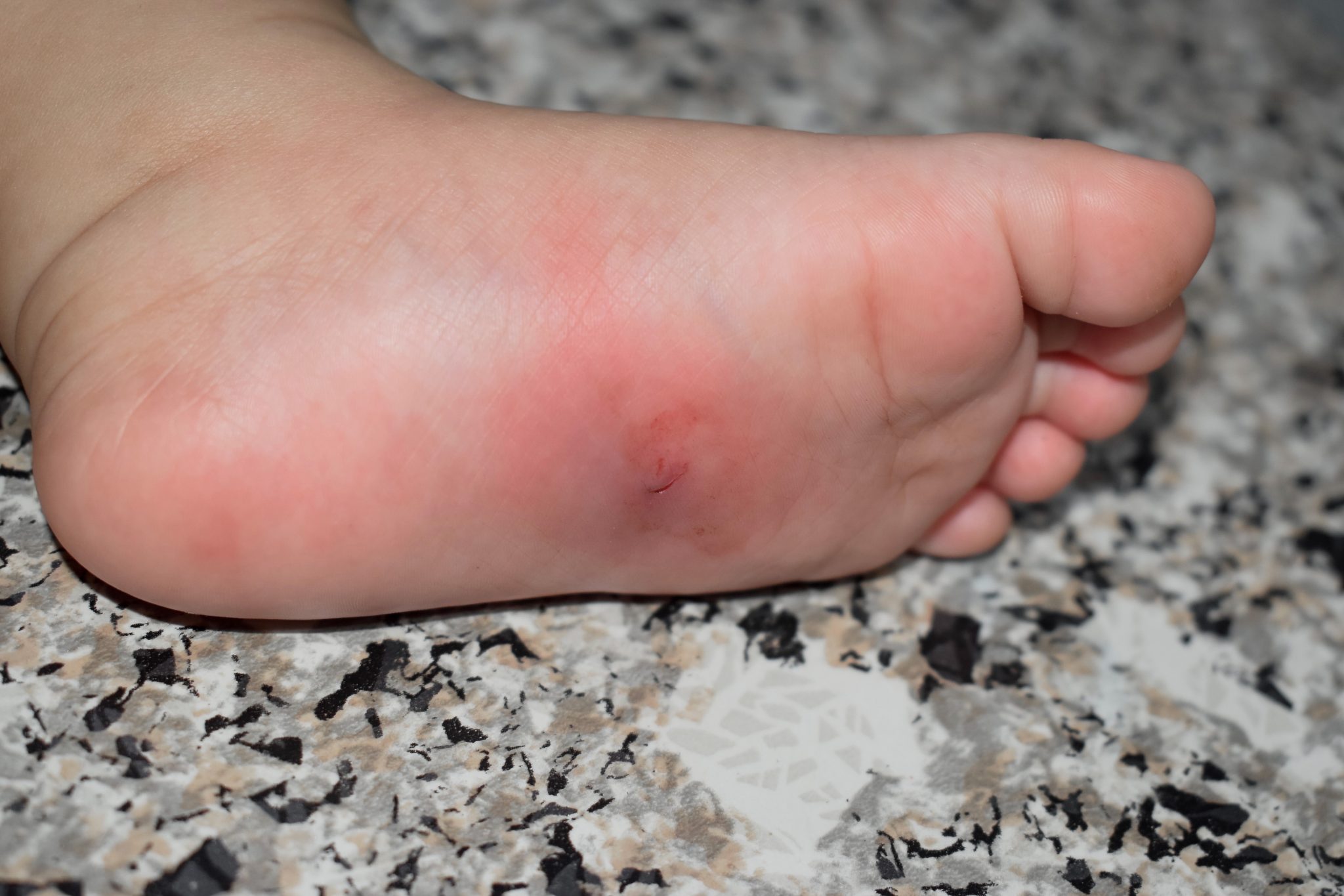 Skin rashes in children | NHS inform