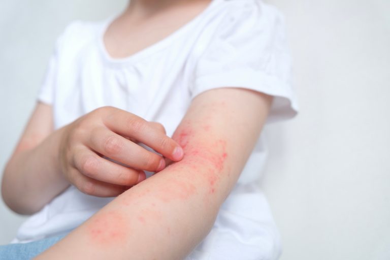 Skin rashes in children | NHS inform