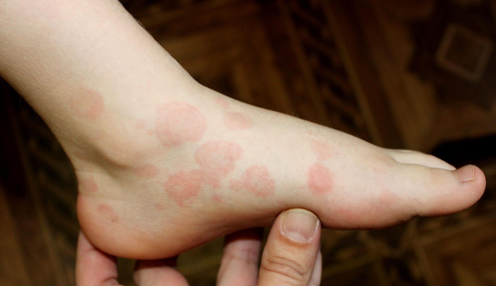 Skin rashes in children | NHS inform
