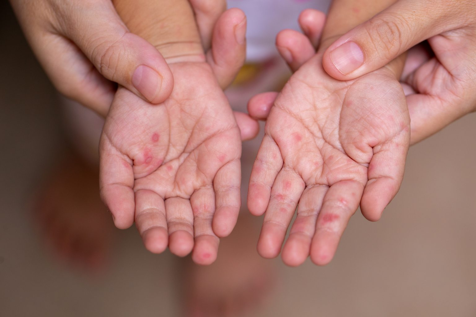 Skin rashes in children | NHS inform