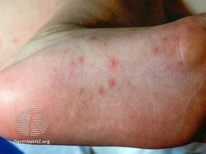 Skin rashes in children | NHS inform