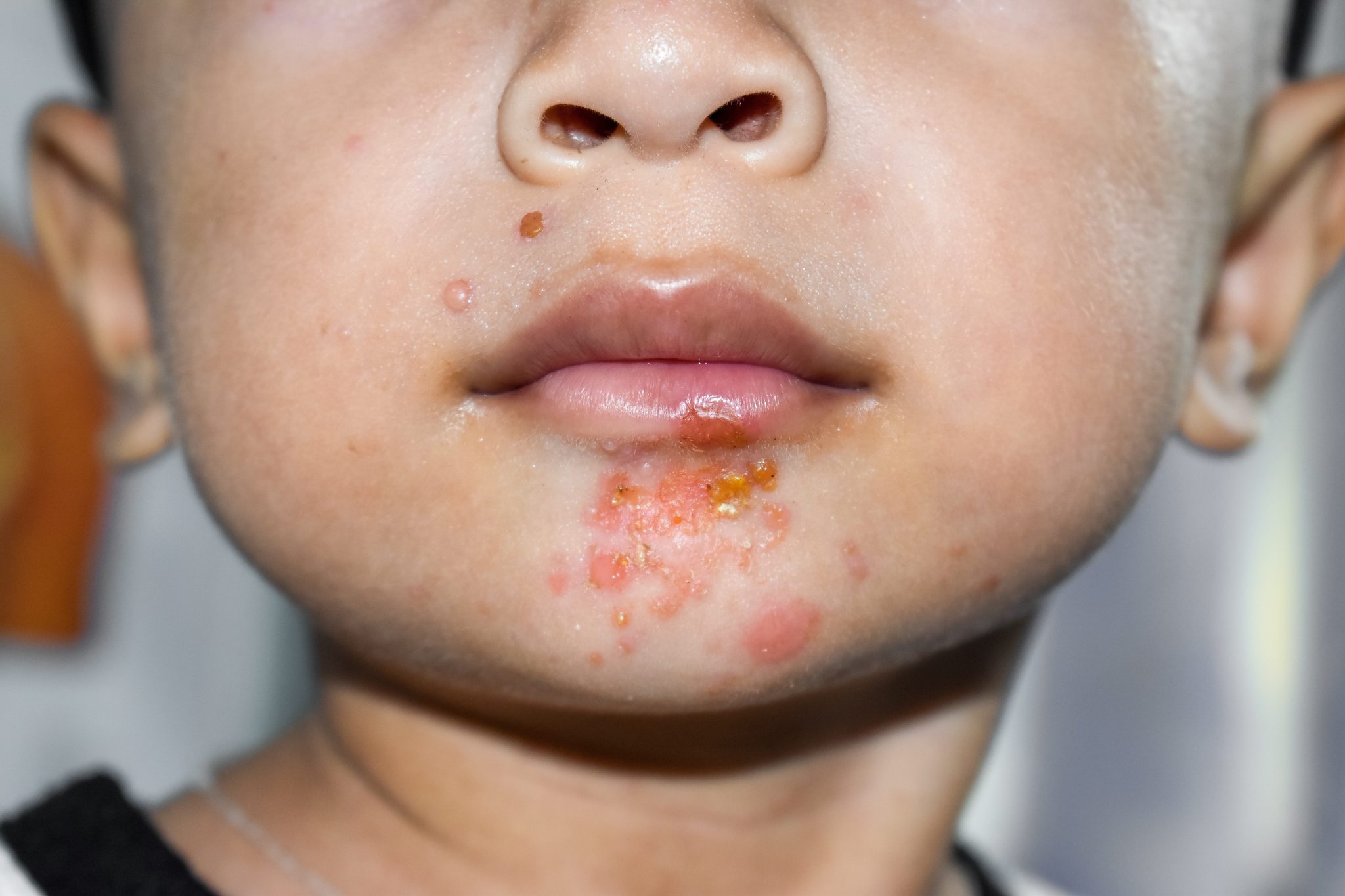 Skin rashes in children | NHS inform
