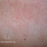 Skin rashes in children | NHS inform