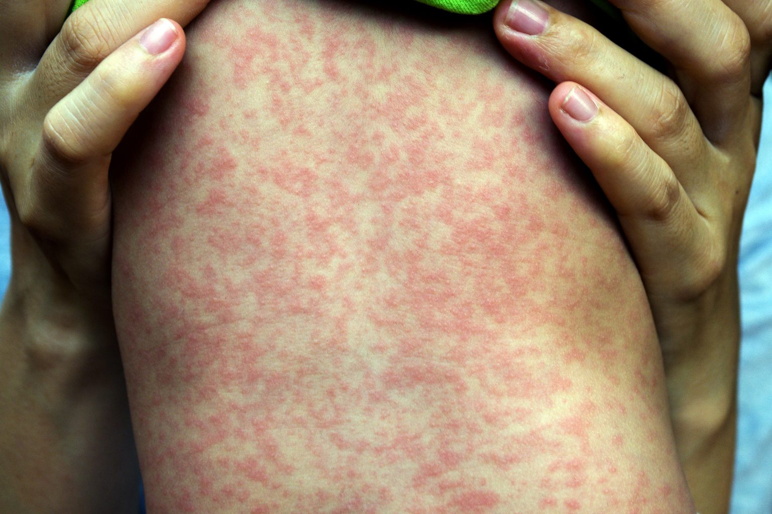 Skin rashes in children | NHS inform
