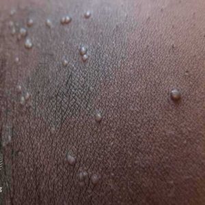 Skin rashes in children | NHS inform