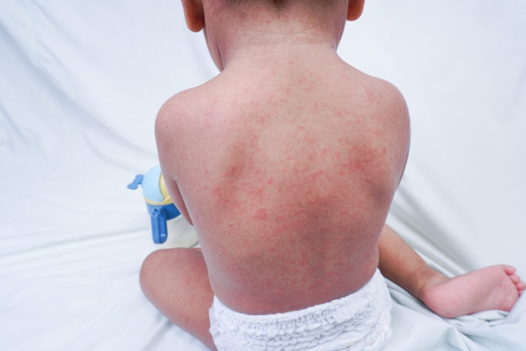 Heat Rash On Black Babies