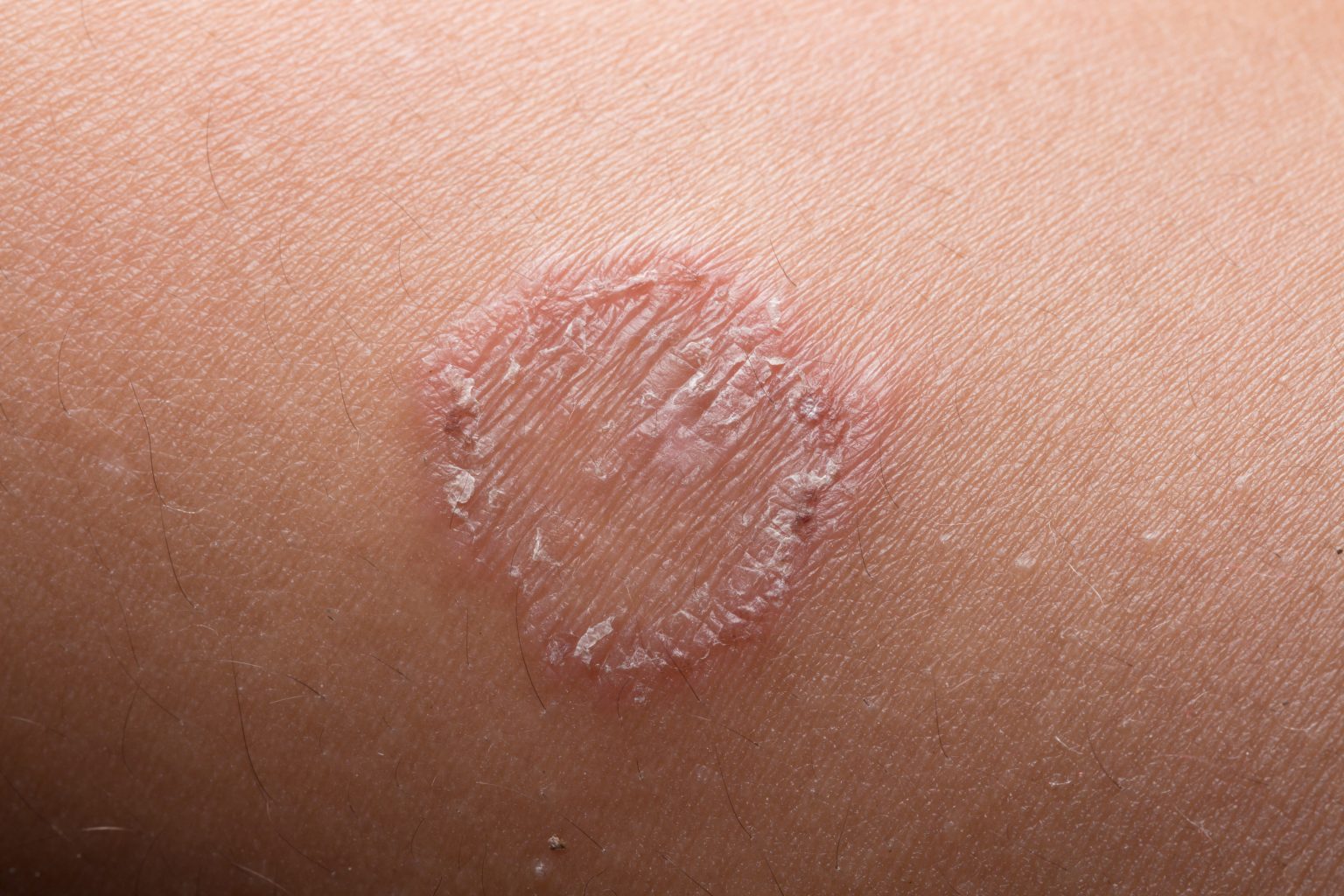 Skin rashes in children | NHS inform