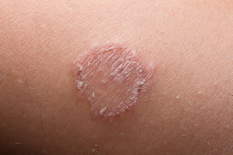 Skin rashes in children | NHS inform
