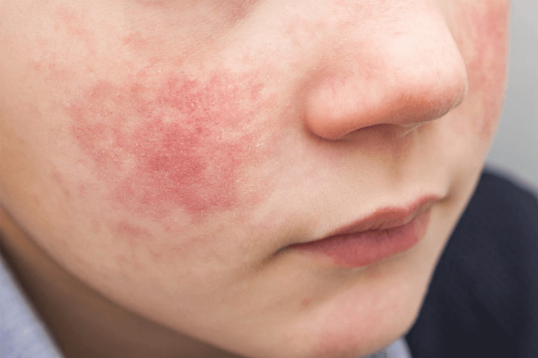 Skin rashes in children | NHS inform