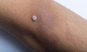 Warts and verrucas | NHS inform