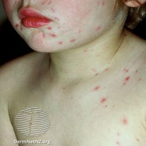 Skin rashes in children | NHS inform