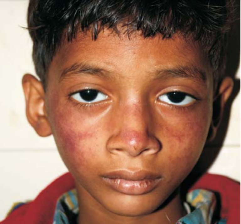 Slapped cheek syndrome | NHS inform