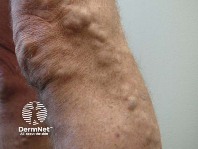 Varicose Veins Legs