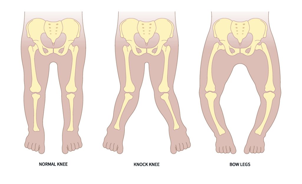 Knock Knees What Are The Causes Of Knock Knees? | JaipurJoints