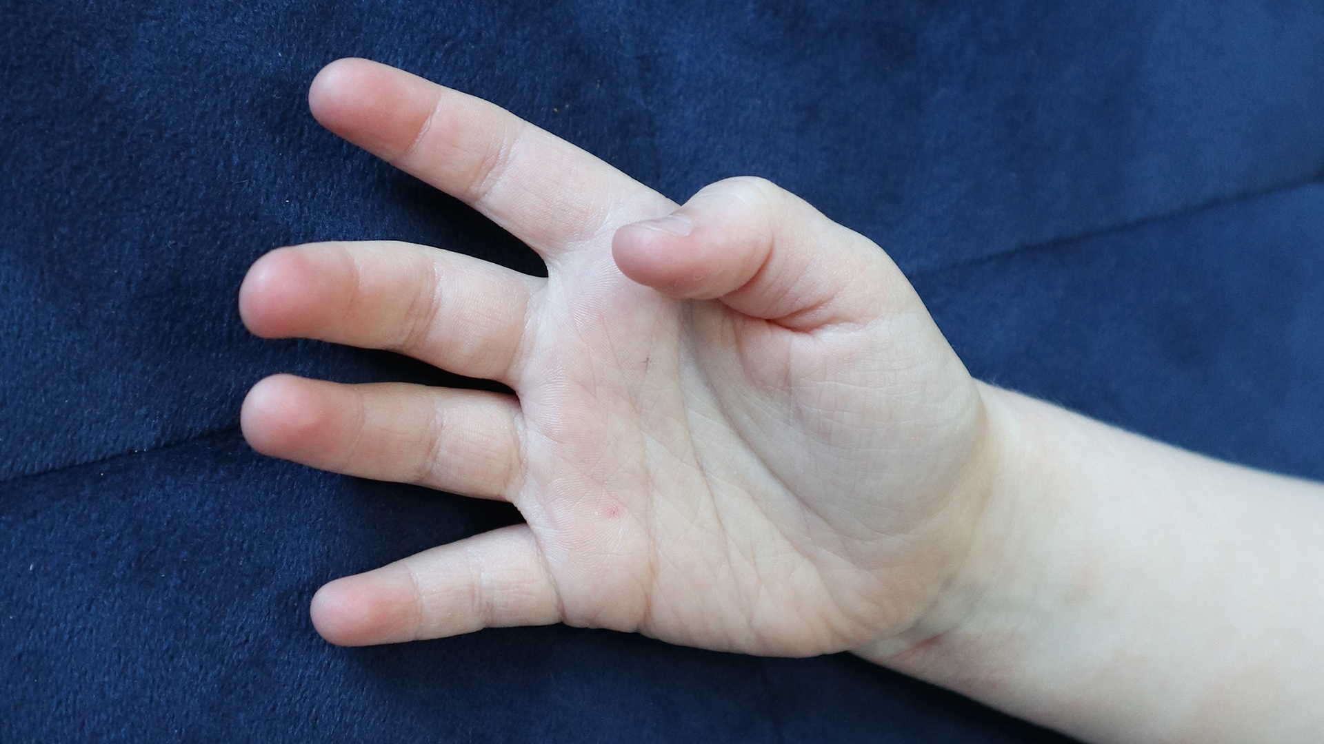Trigger thumb or finger in children and young people | NHS inform