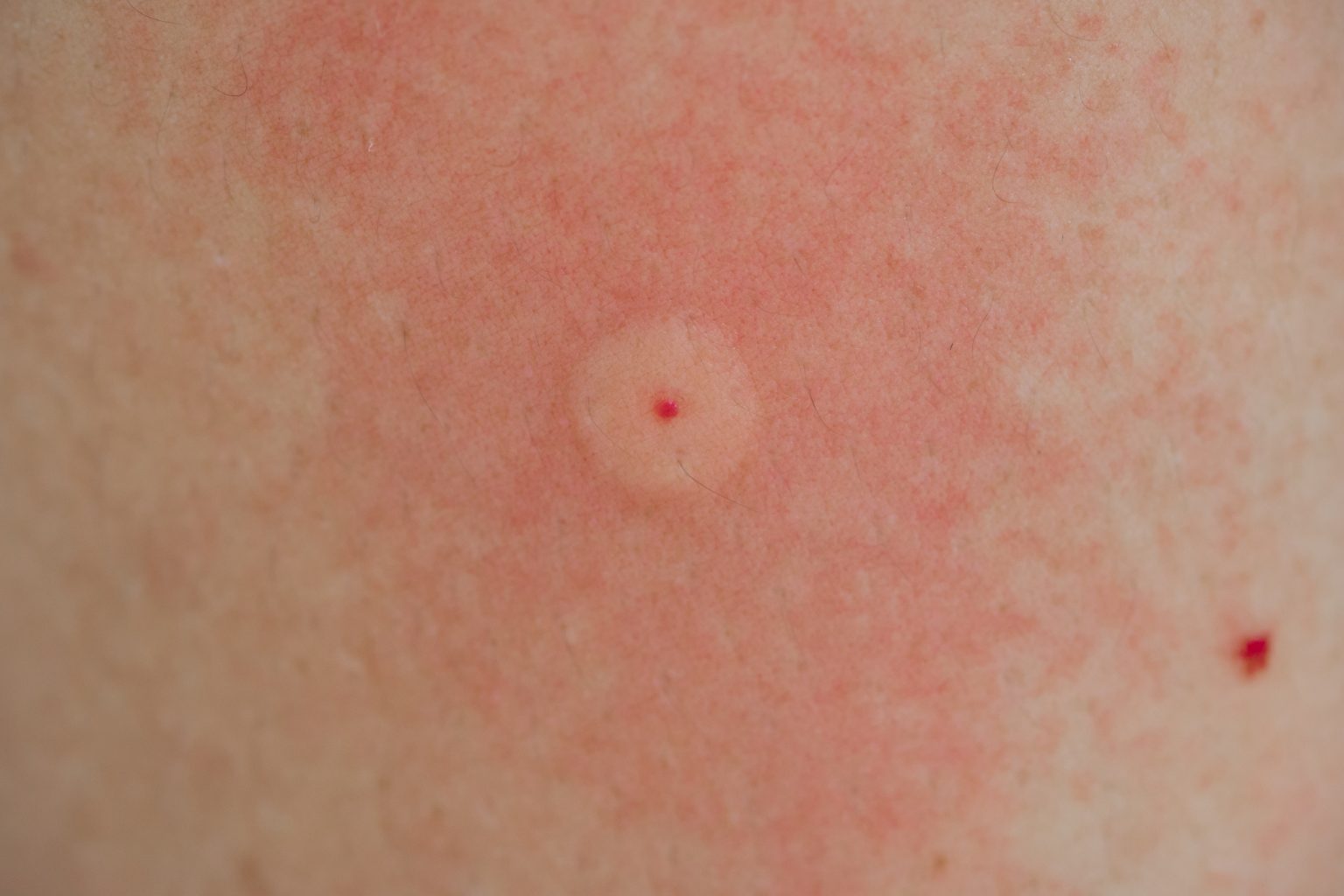 Types of bites and stings | NHS inform