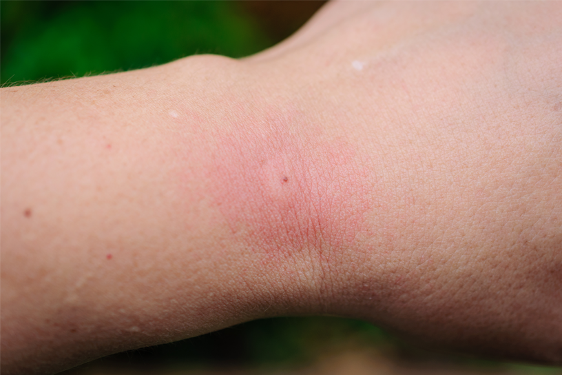 Types of bites and stings | NHS inform