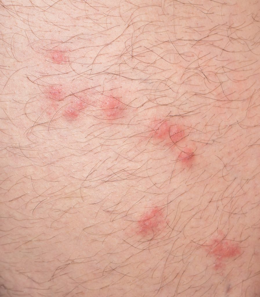 Types of bites and stings | NHS inform