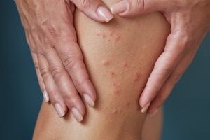 Types of bites and stings | NHS inform
