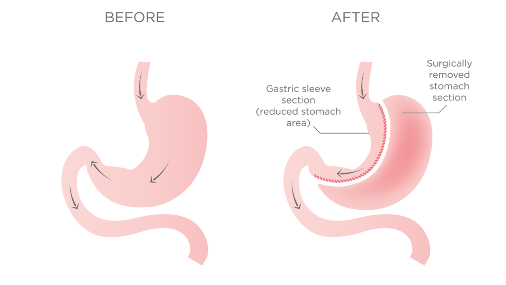 Weight loss surgery (metabolic and bariatric surgery) | NHS inform