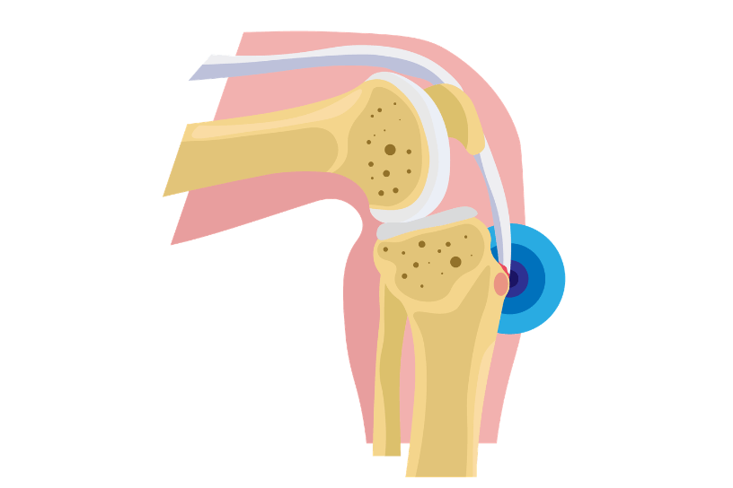 Knee apophysitis (Osgood Schlatter’s and Sinding-Larsen Johansson ...